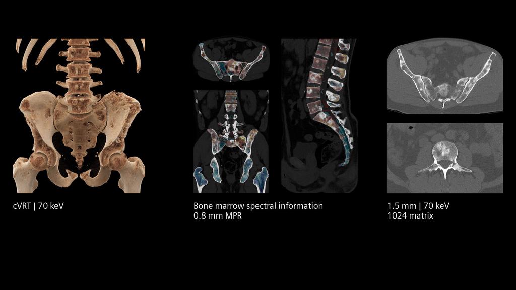 Photon-counting CT musculoskeletal imaging - Siemens Healthineers