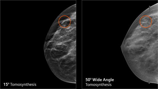 MAMMOMAT Revelation - Siemens Healthineers