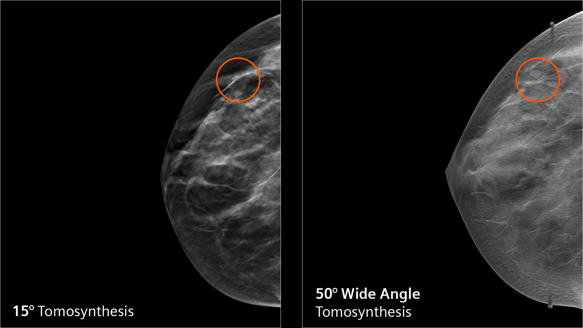 MAMMOMAT Revelation - Siemens Healthineers