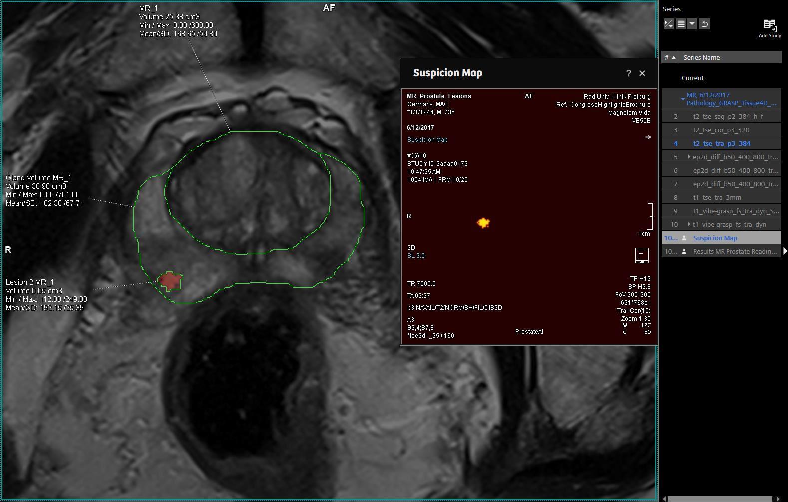 MR Prostate – AI-based segmentation and classification