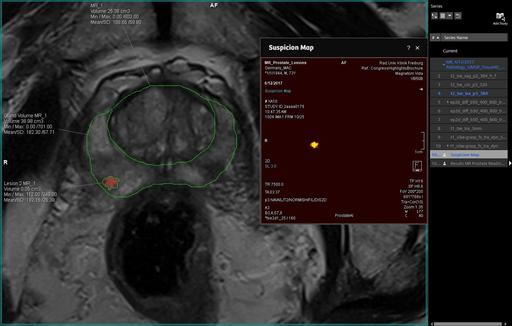 MR Prostate – AI-based segmentation and classification