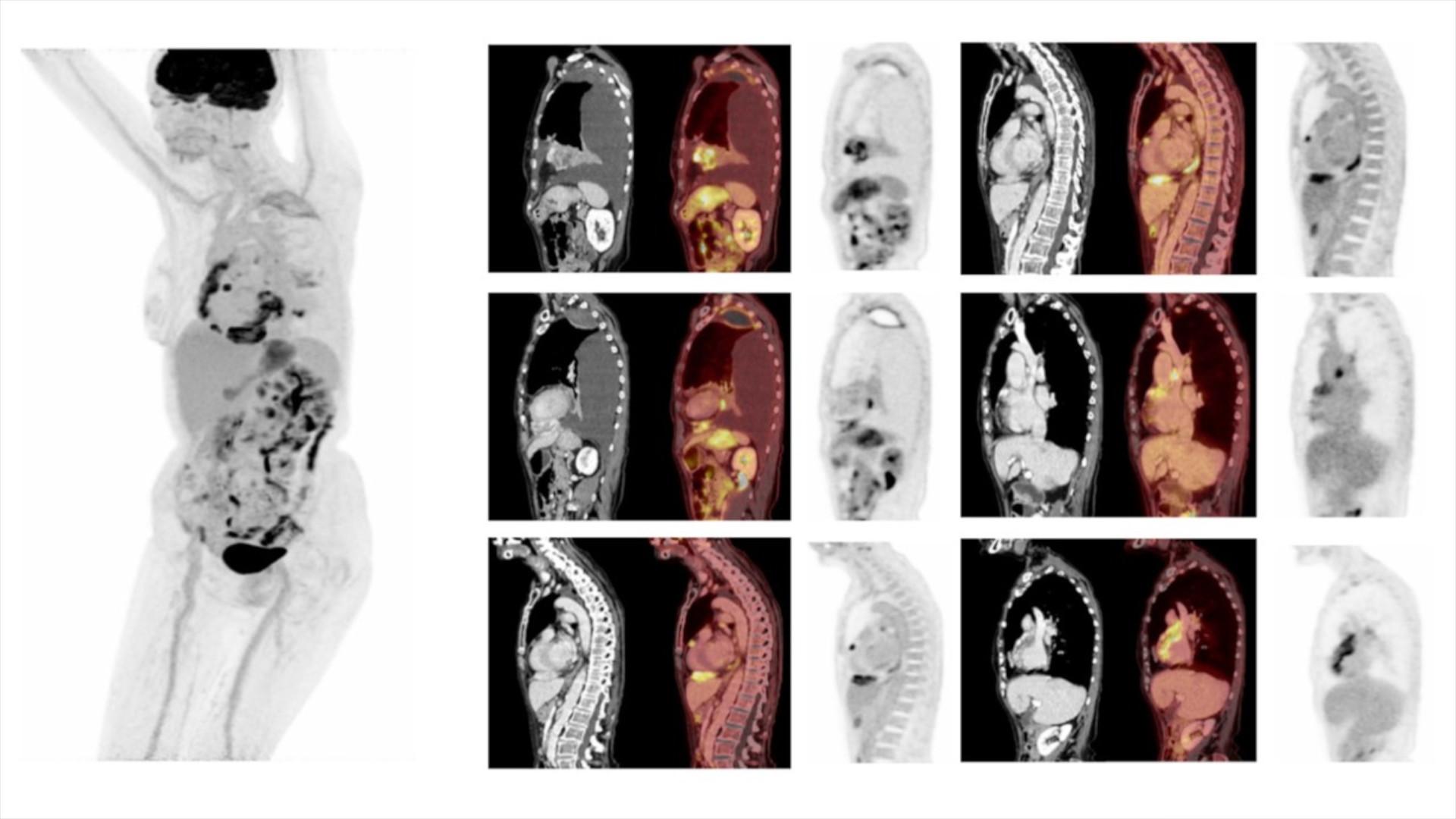 18F-FDG PETCT delineation of predominantly pericardial involvement in ...