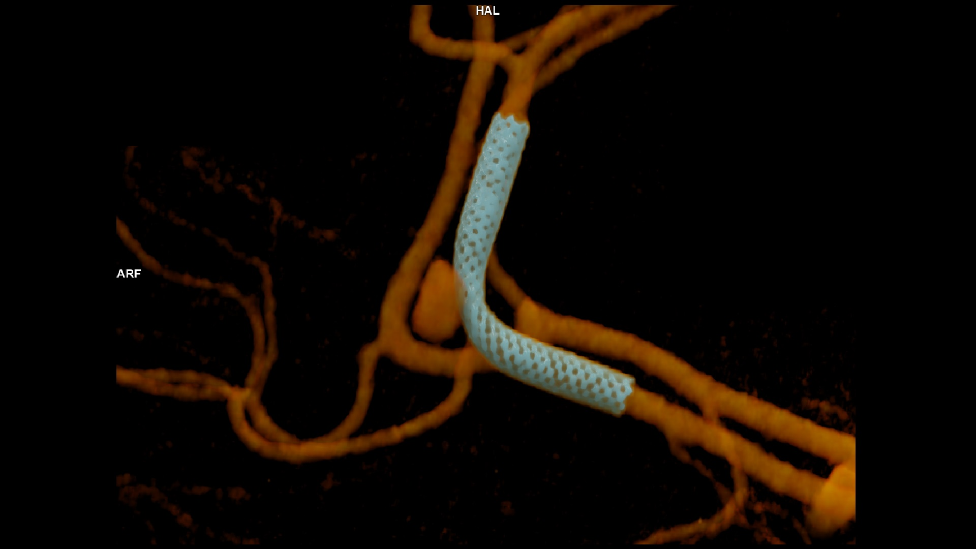 Follow up on an unruptured intracranial aneurysm treated with a flow ...