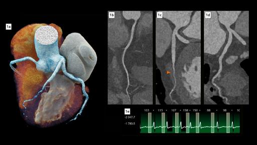 Triple-rule-out evaluation of acute chest pain using single source ...