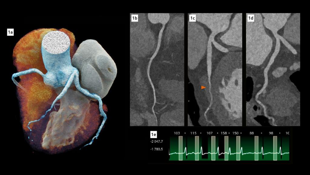 Triple-rule-out evaluation of acute chest pain using single source ...