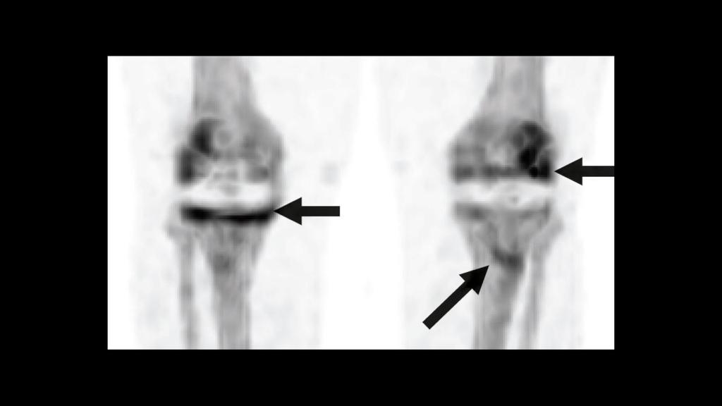 SPECT/CT Detection In TKA Prosthetic Loosening