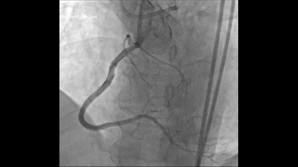 Multimodality Imaging in the Cath Lab for Guidance During CTO Treatment