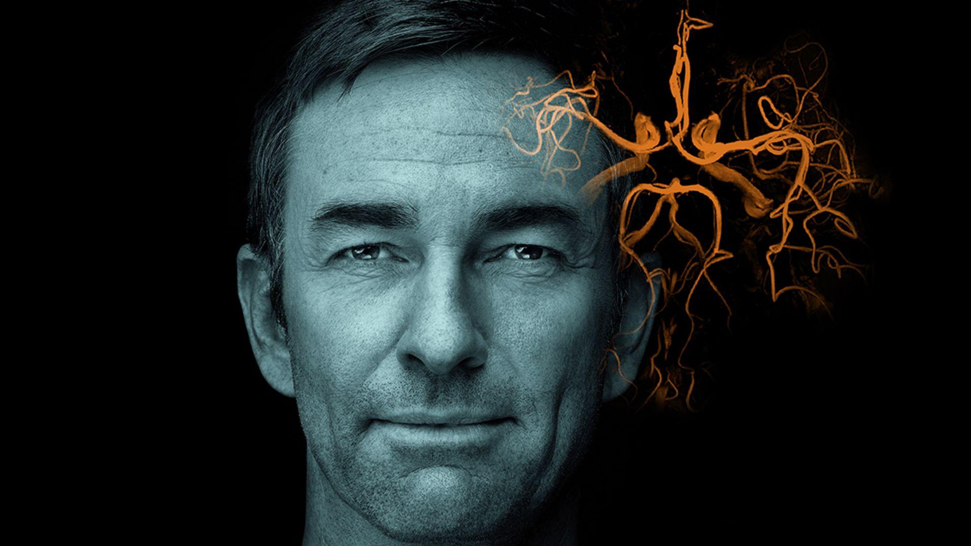 Improving the stroke pathway in southern Sweden