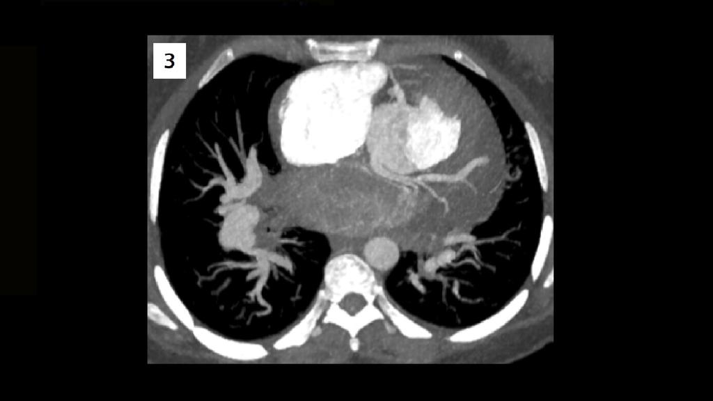 Unrepaired persistent truncus arteriosus in an adult - Siemens Healthineers