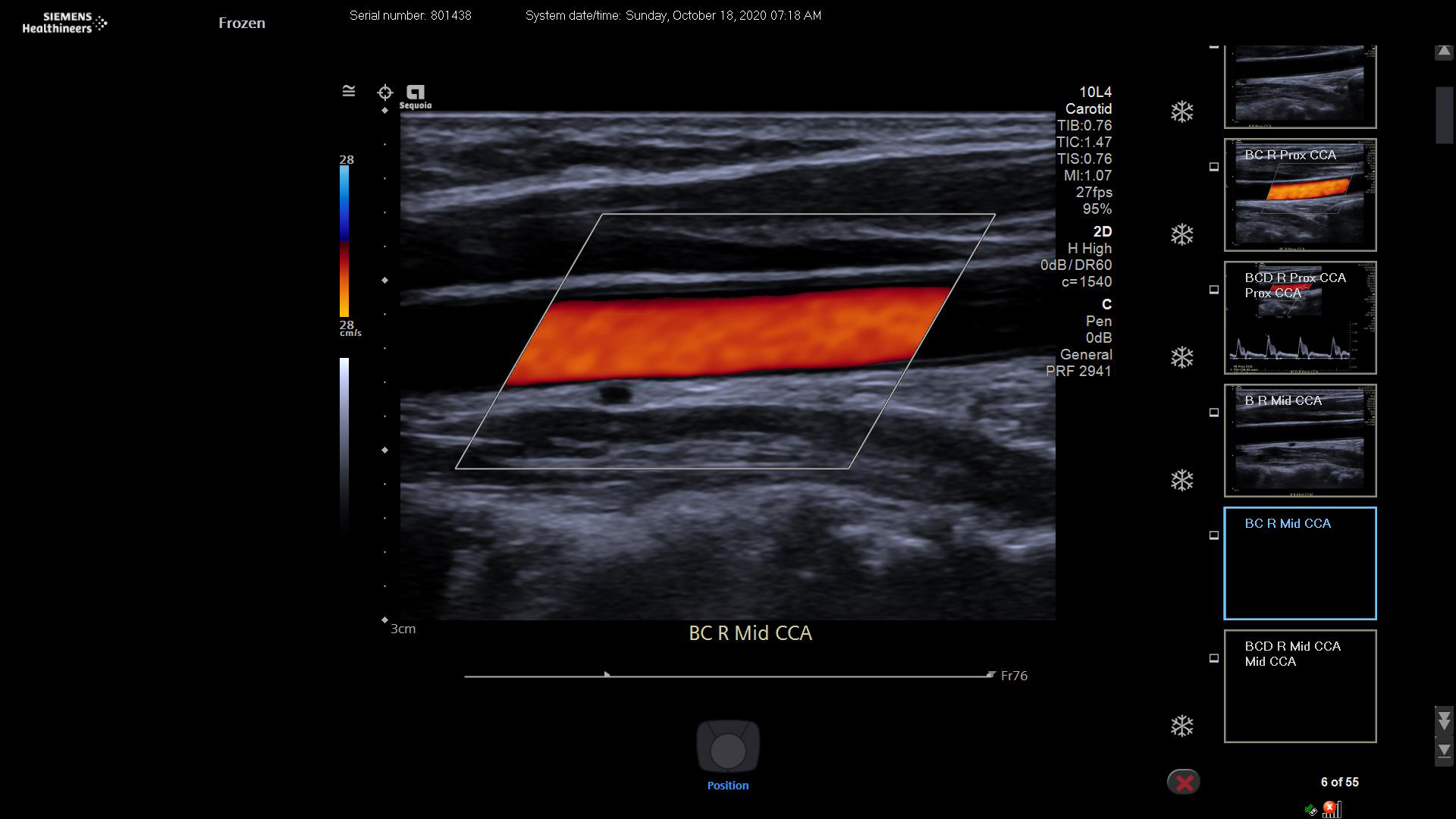 ACUSON Sequoia Ultrasound System - Siemens Healthineers