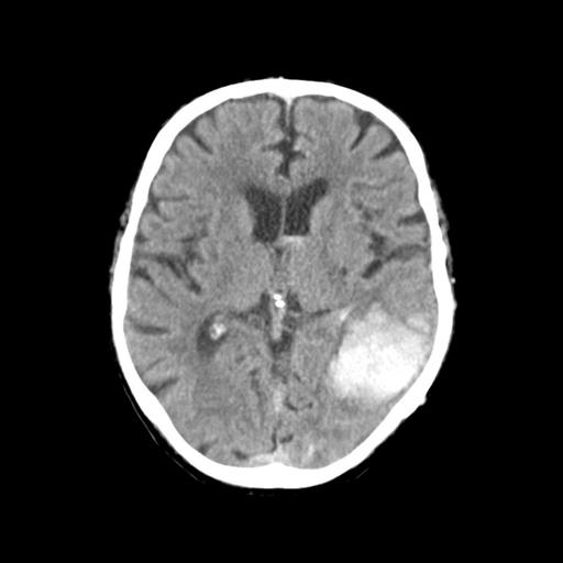 Advanced Stroke Management & Patient Care - Siemens Healthineers USA