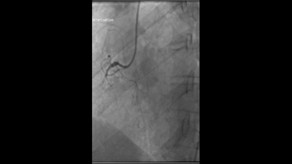 Multimodality Imaging in the Cath Lab for Guidance During CTO Treatment