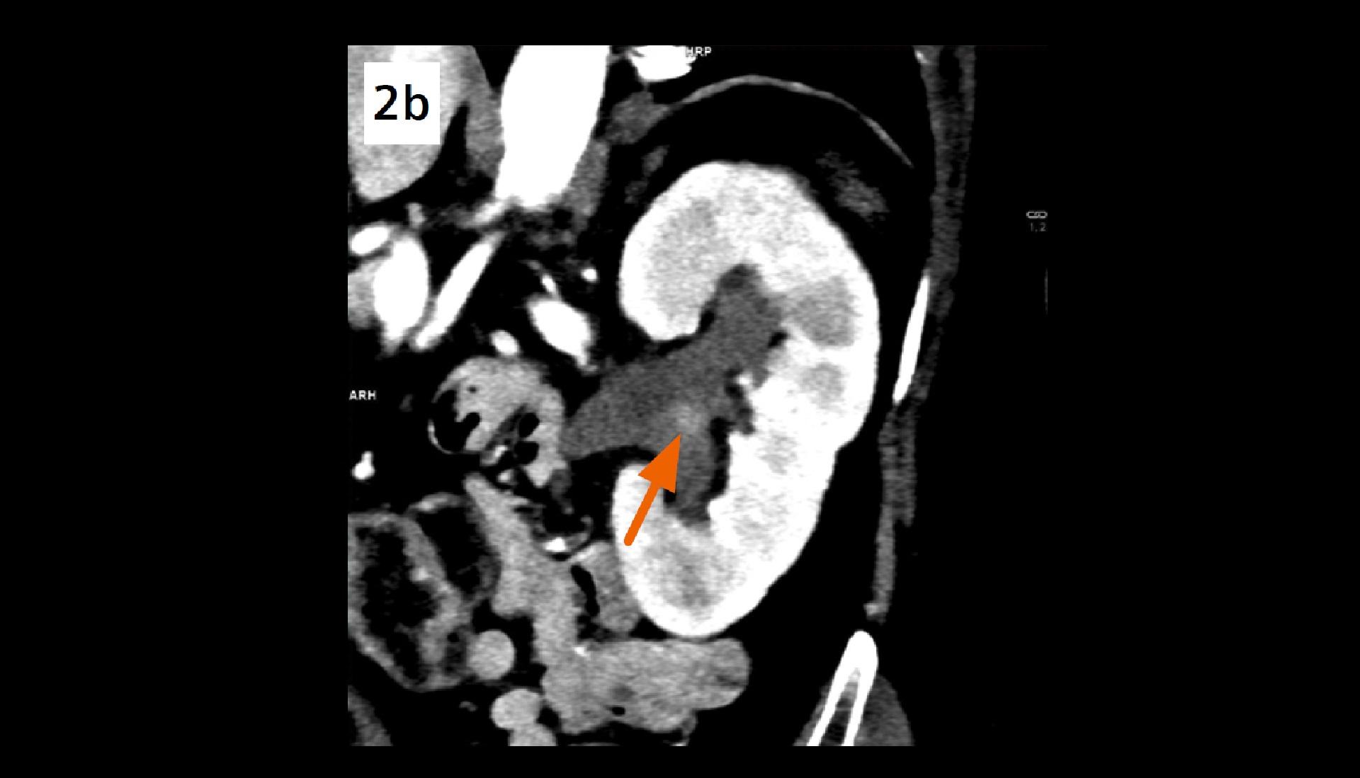Severe Ureteral Obstruction Secondary to an Upper Urinary Tract ...