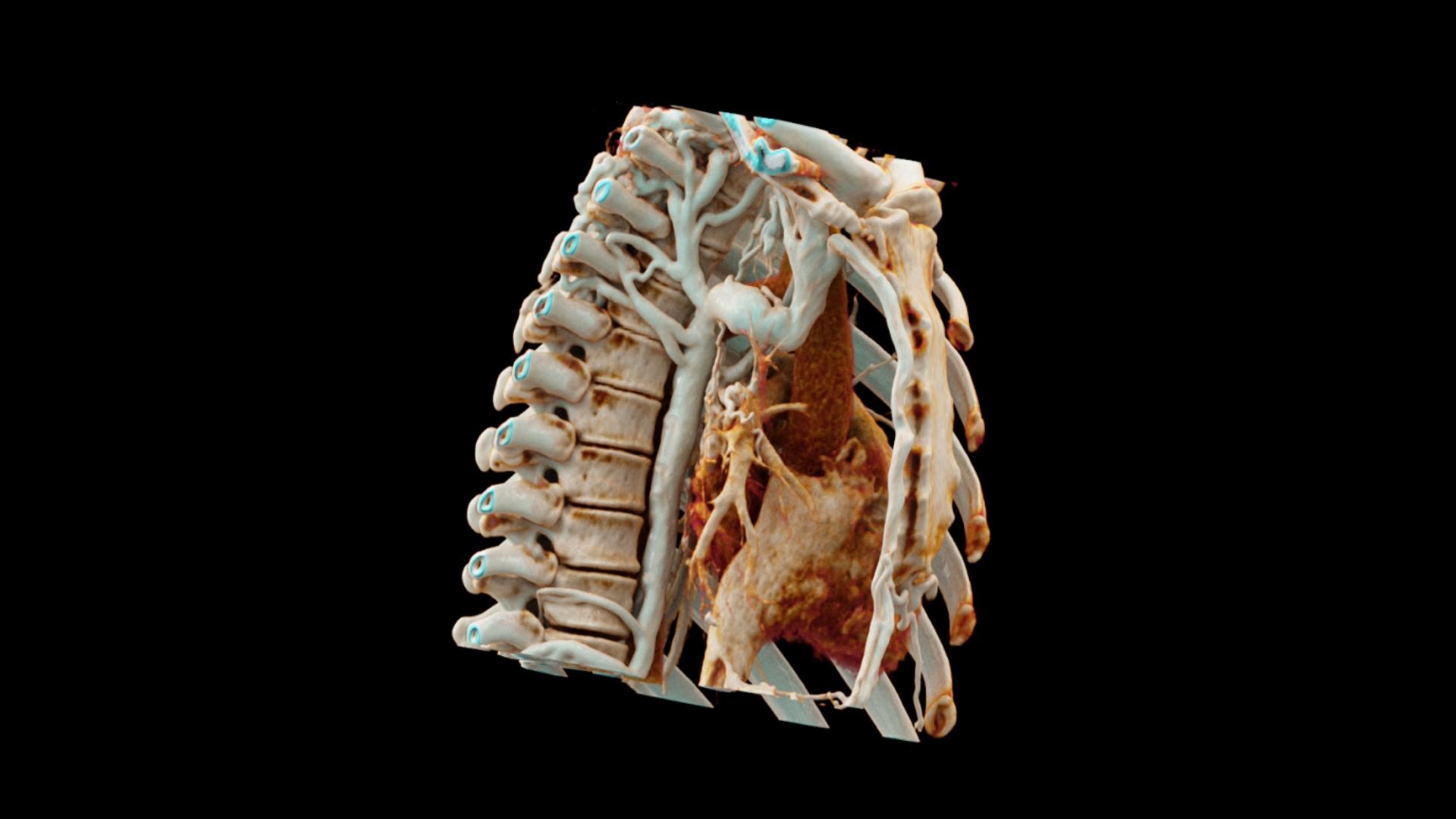 Superior vena cava obstruction caused by a primary mediastinal large B ...