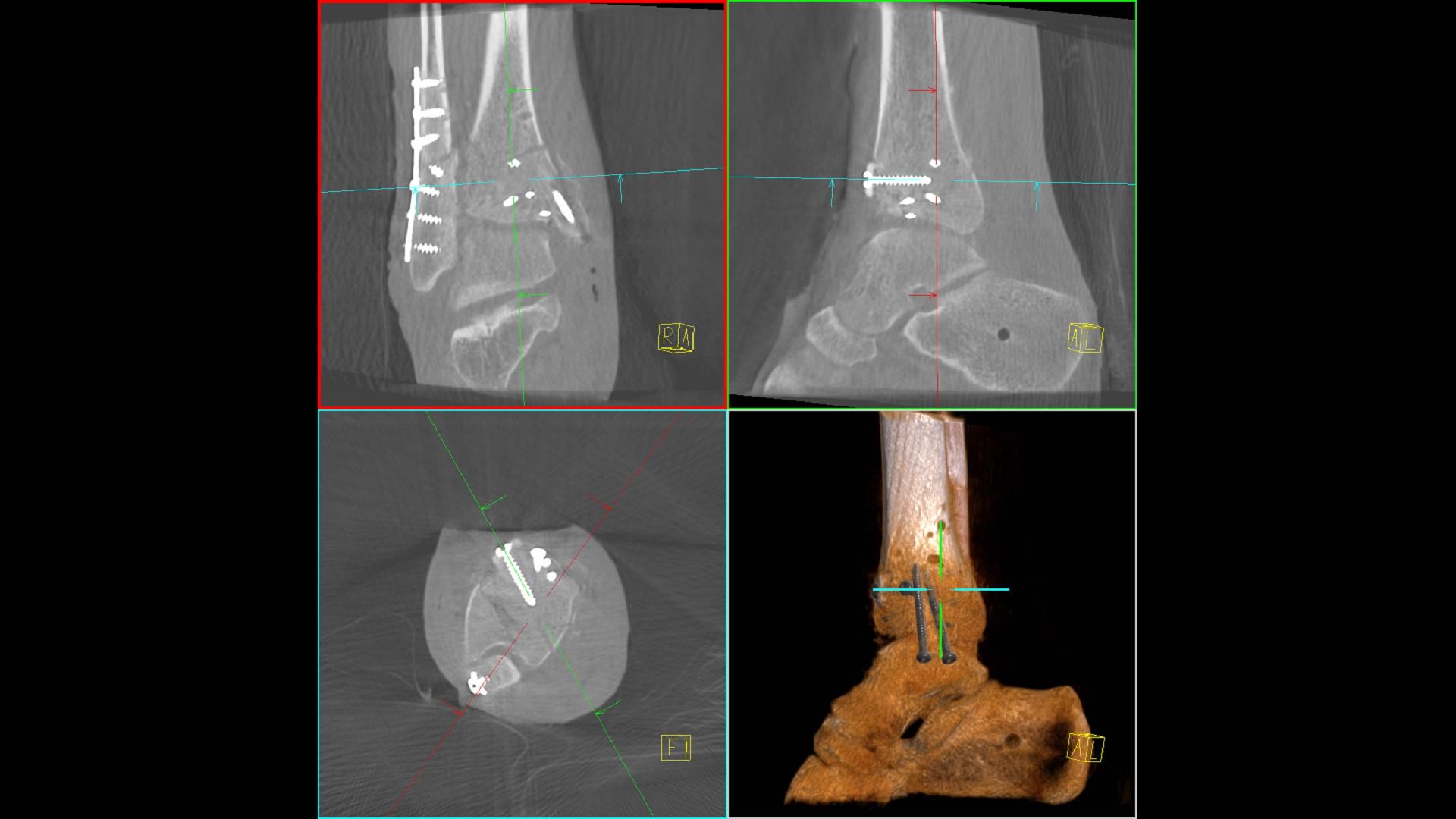 Cios Spin – Mobile C-arm machine - Siemens Healthineers