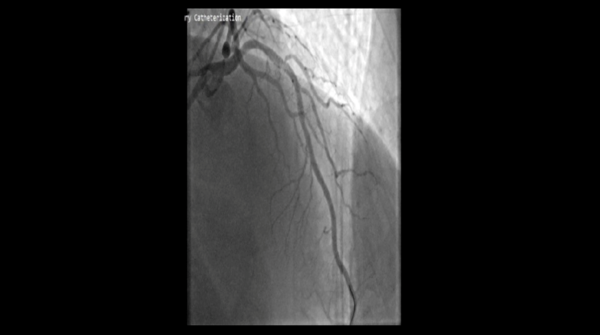 Multimodality Imaging in the Cath Lab for Guidance During CTO Treatment