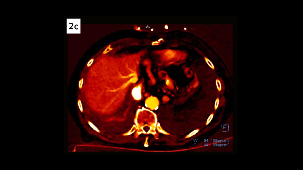 Small bowel infarction secondary to an acquired diaphragmatic hernia ...