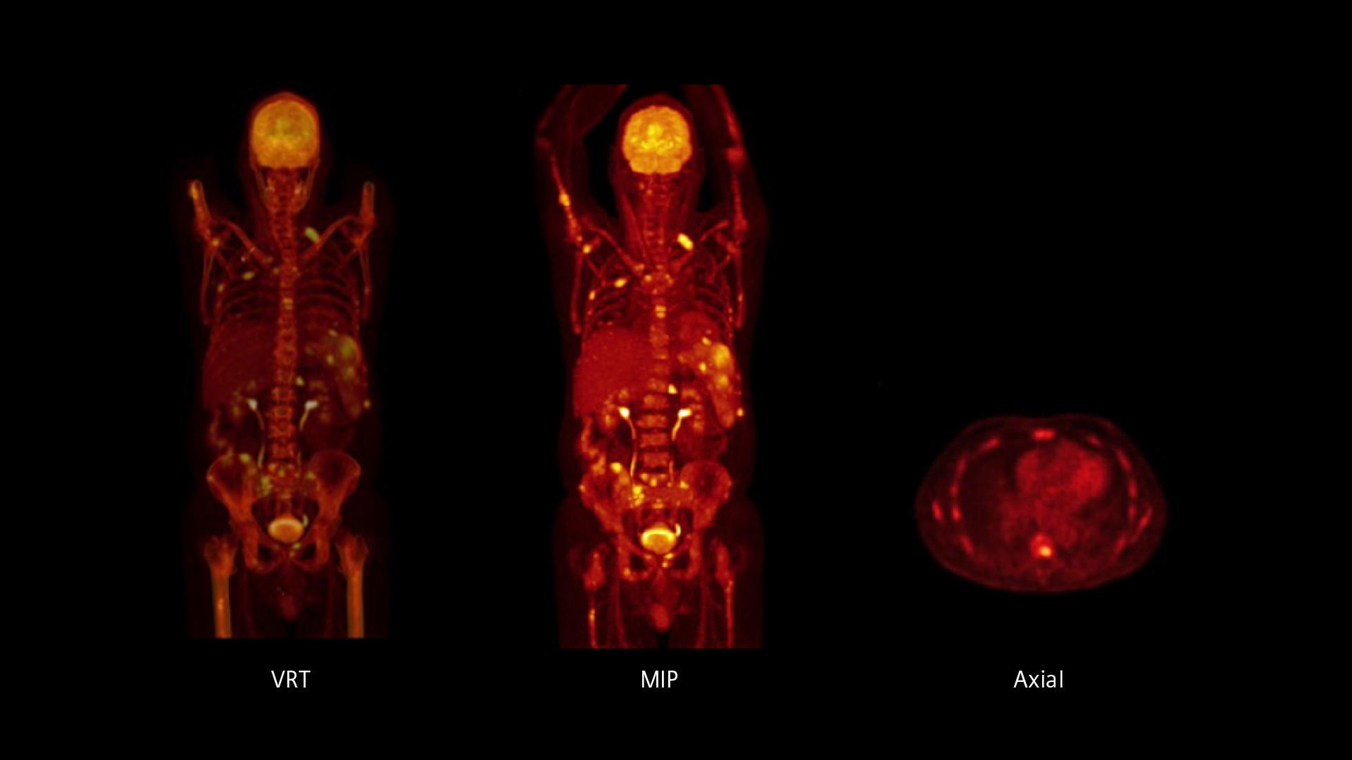 Biograph Trinion PET/CT scanner - Siemens Healthineers