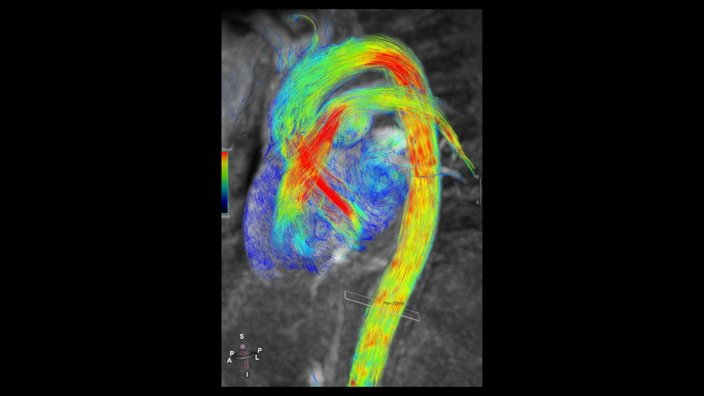 Cardiovascular MRI - Siemens Healthineers