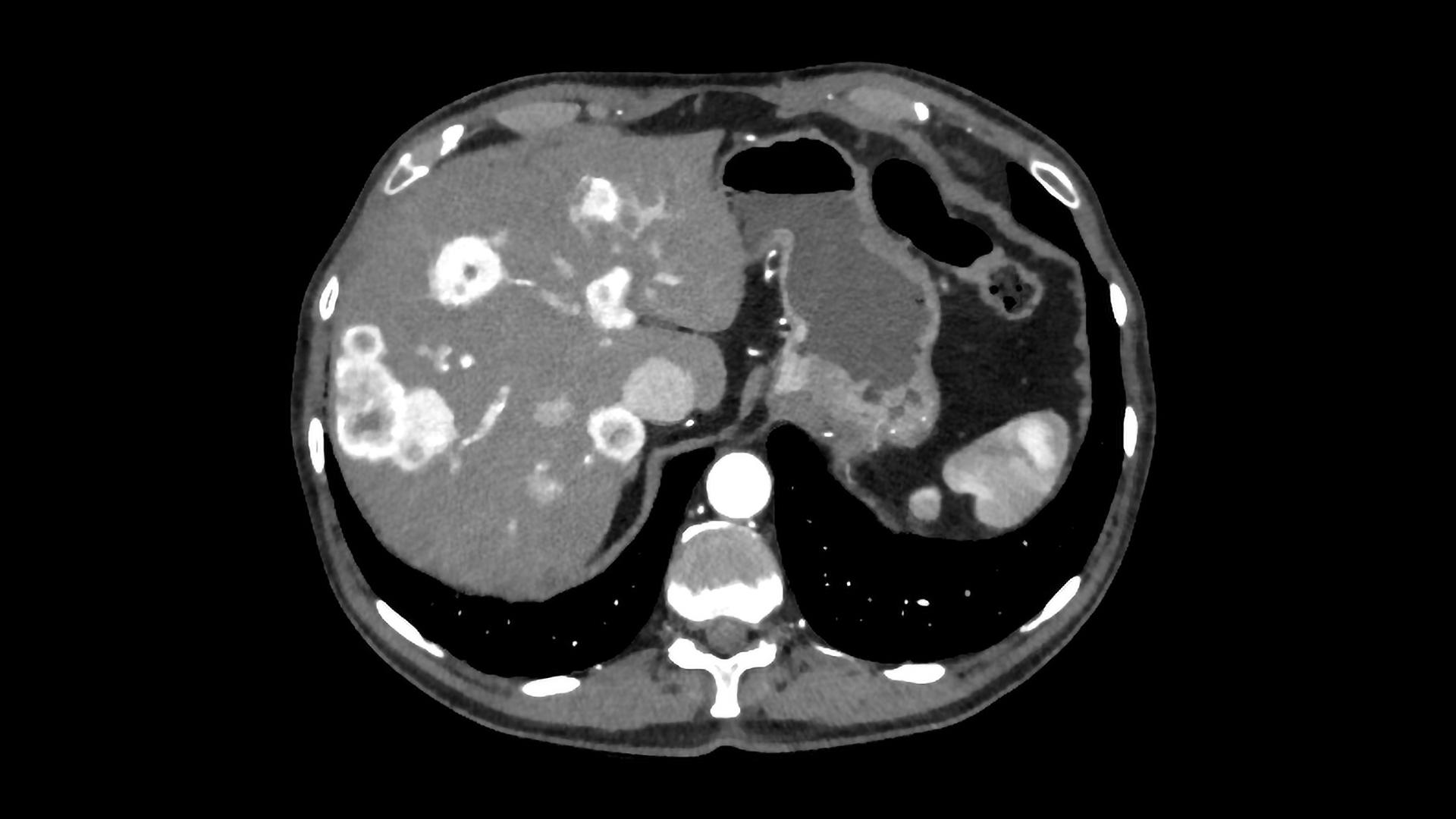 PCCT oncology imaging