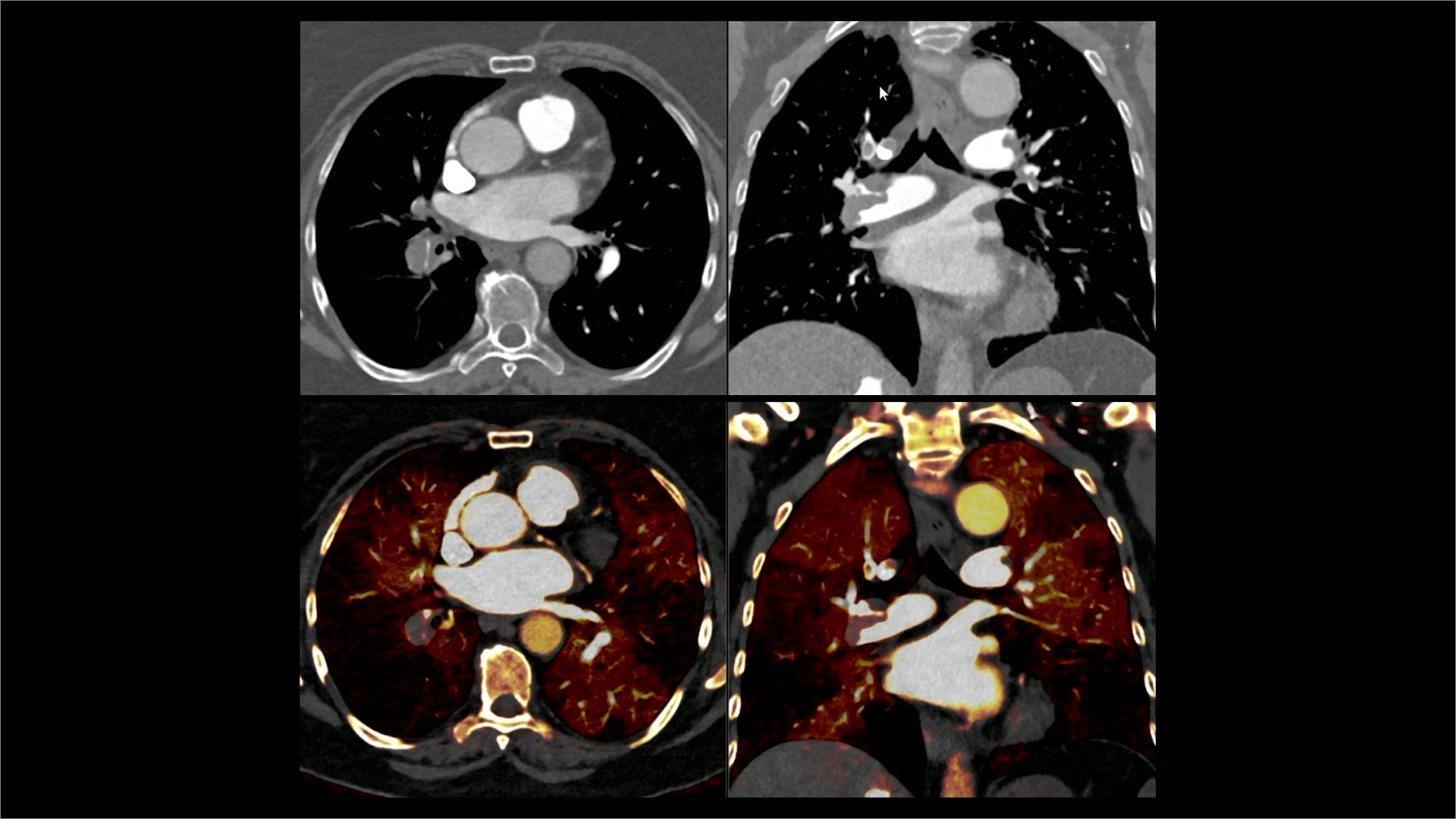 Photon Counting Ct In The Emergency Department Siemens Healthineers Usa
