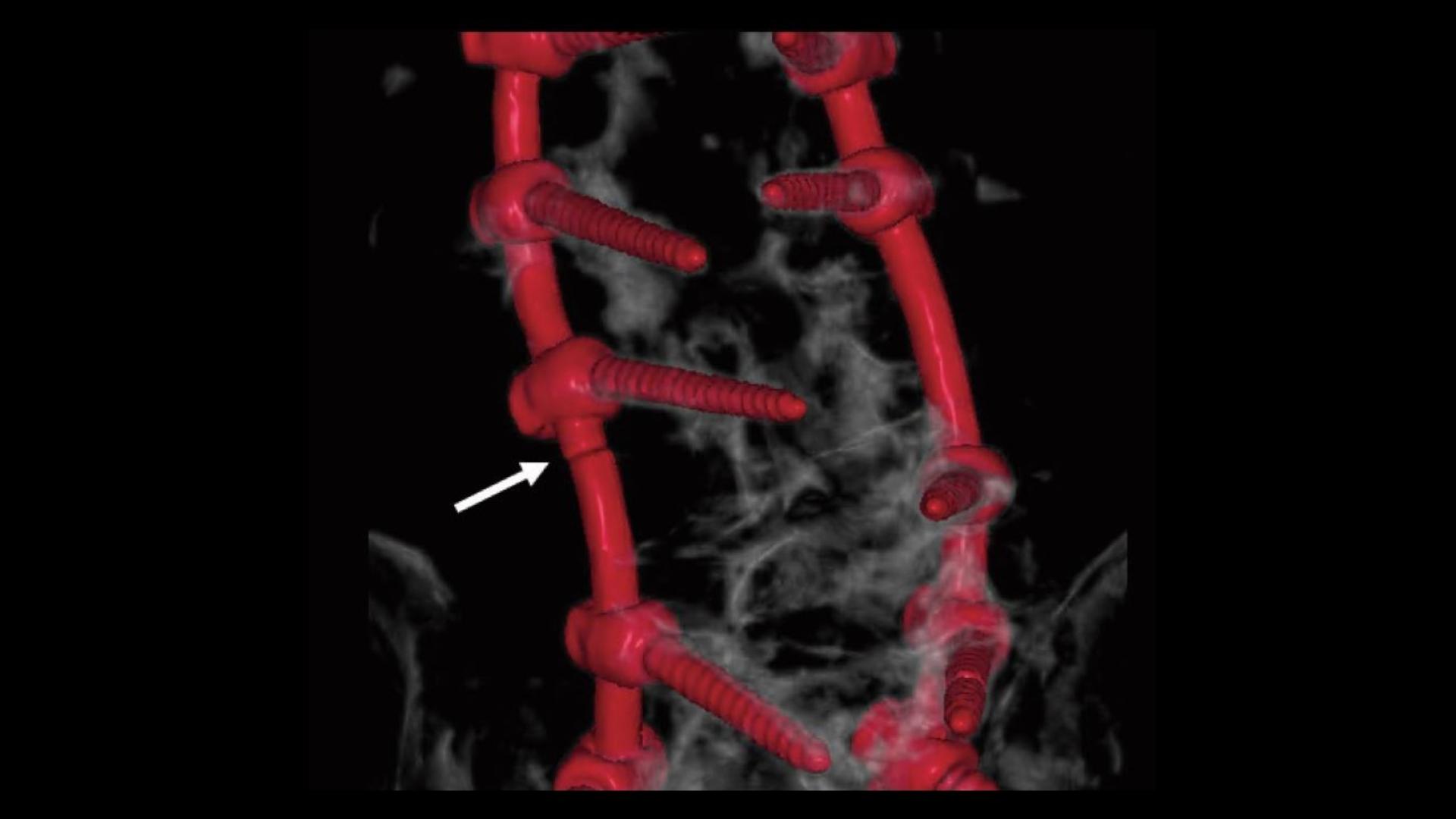 SPECT/CT imaging in the evaluation of pain following spinal fusion ...