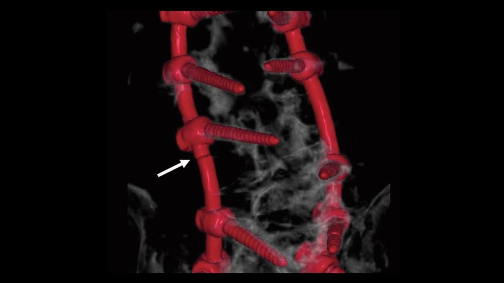 SPECT/CT imaging in the evaluation of pain following spinal fusion ...