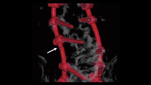 SPECT/CT imaging in the evaluation of pain following spinal fusion ...