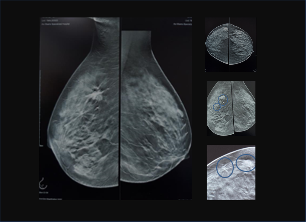 Titanium Contrast Enhanced Mammography (TiCEM) with 50° Wide-Angle HD ...