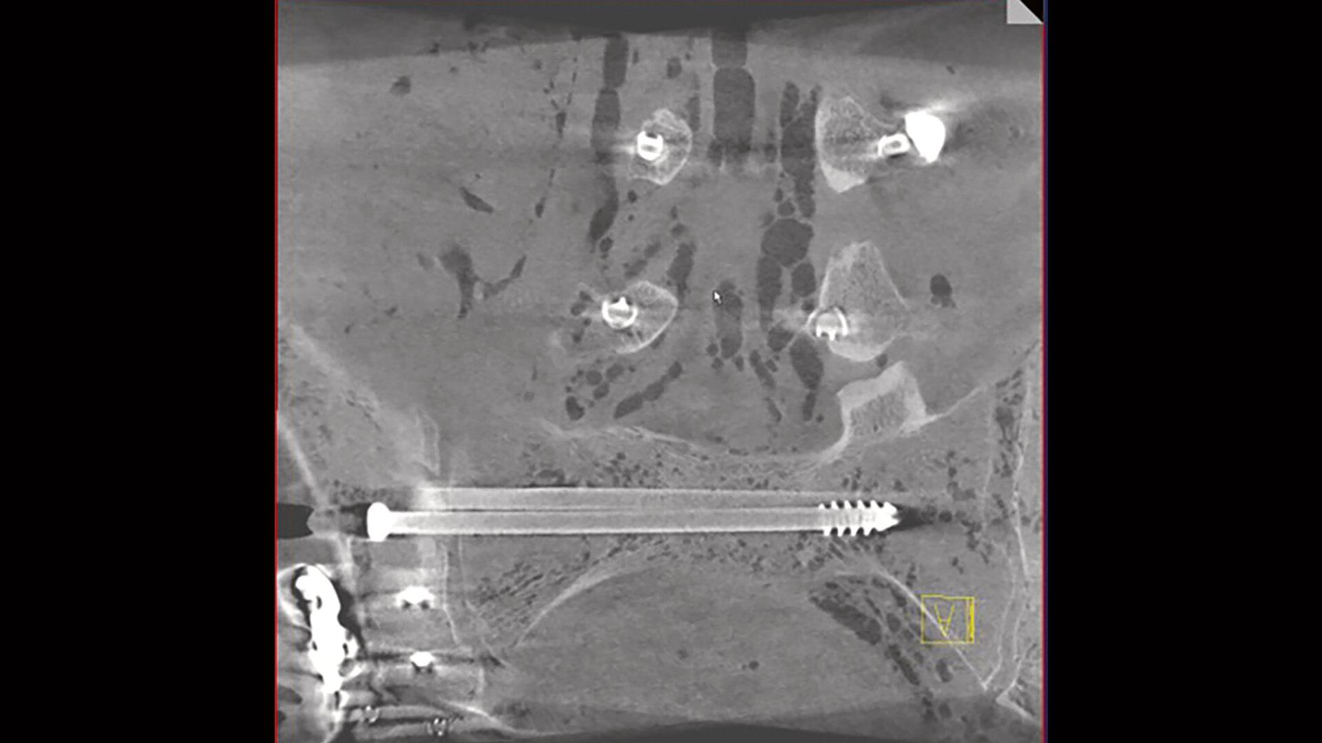 Intraoperative 3D imaging in orthopedic trauma surgery - Siemens ...