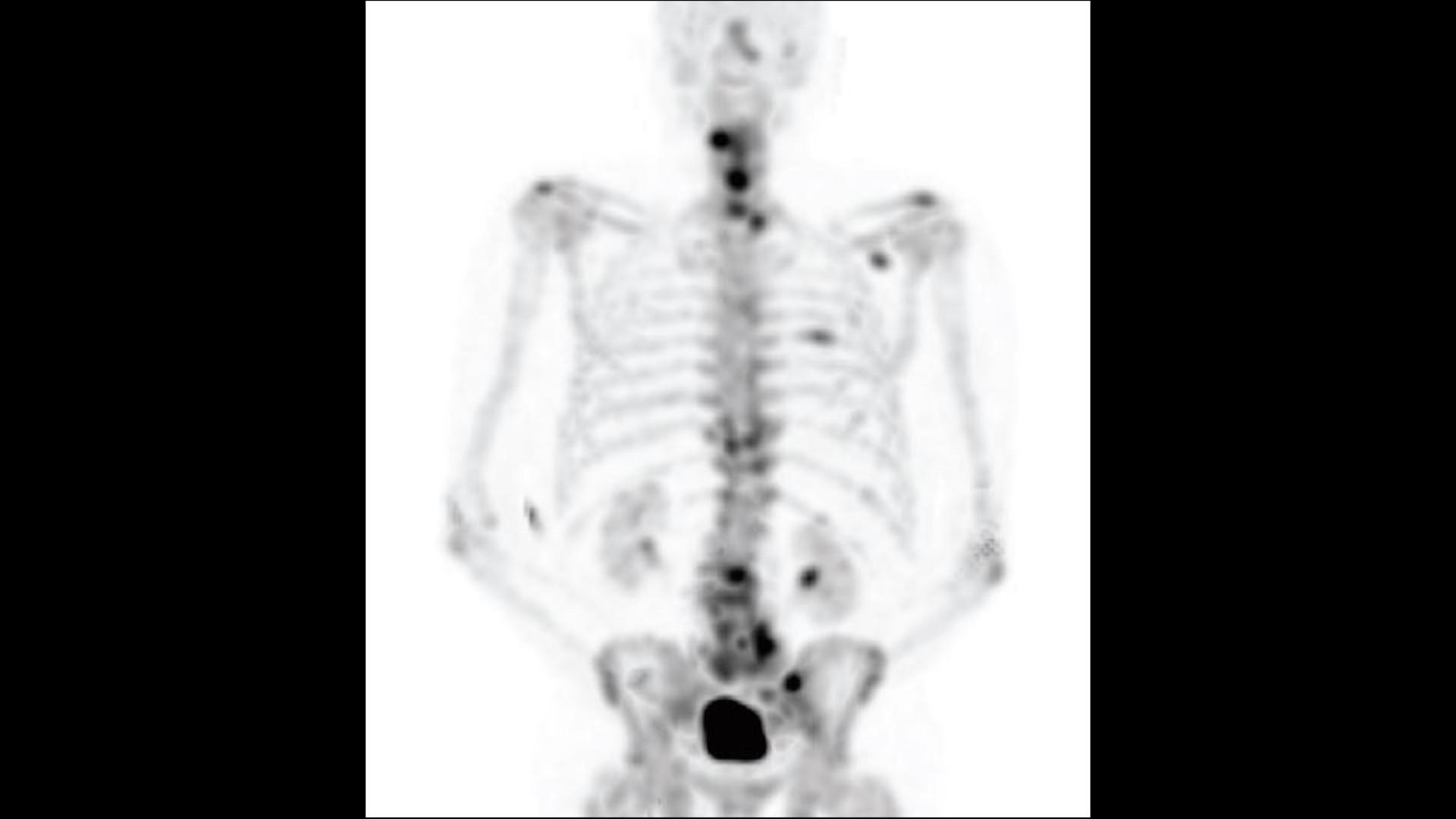 SPECT/CT imaging in the evaluation of pain following spinal fusion ...