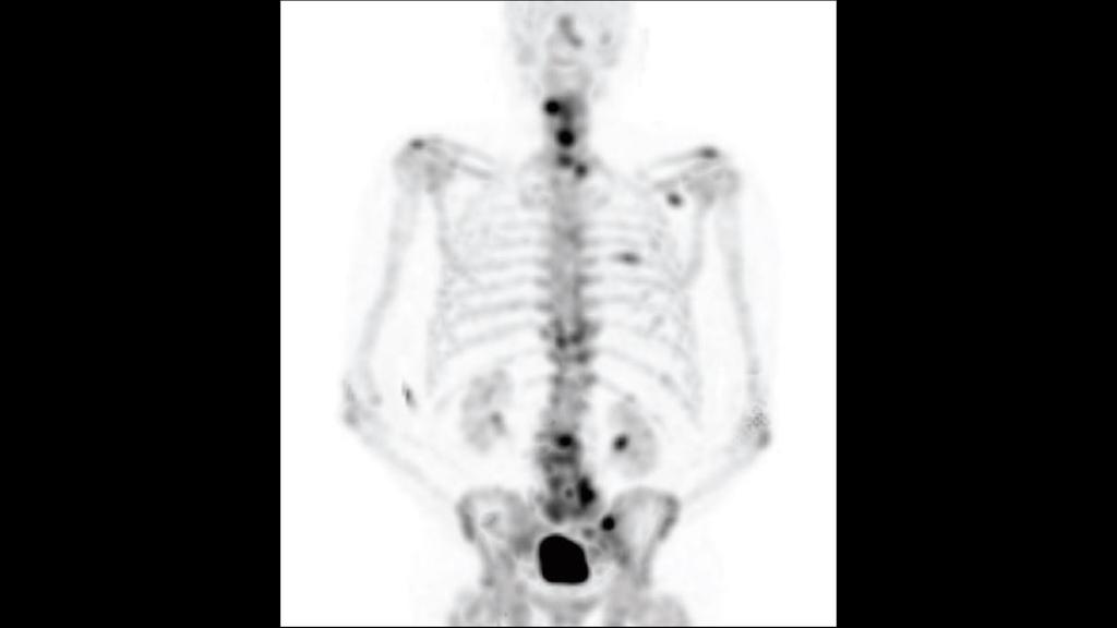SPECT/CT imaging in the evaluation of pain following spinal fusion ...