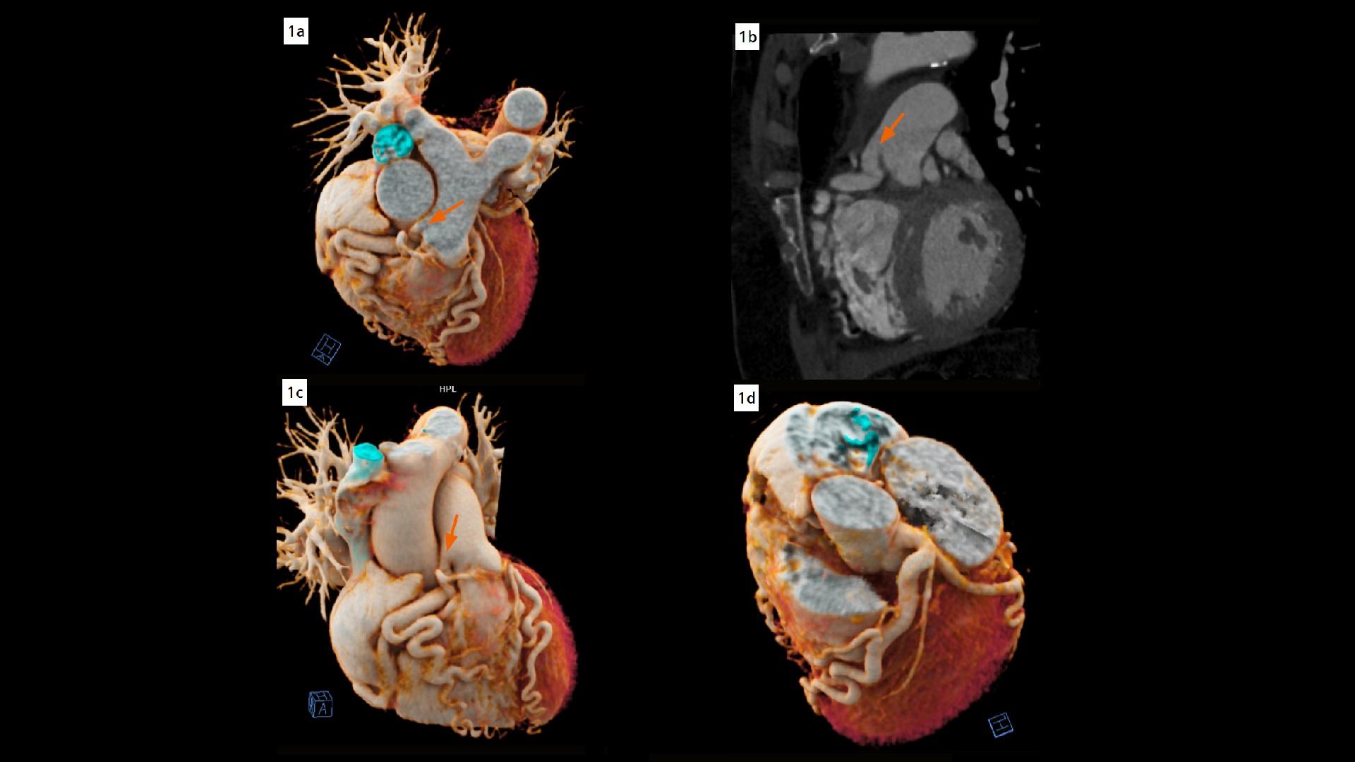 ARCAPA Syndrome – An Incidental Finding in an Adult - Siemens ...