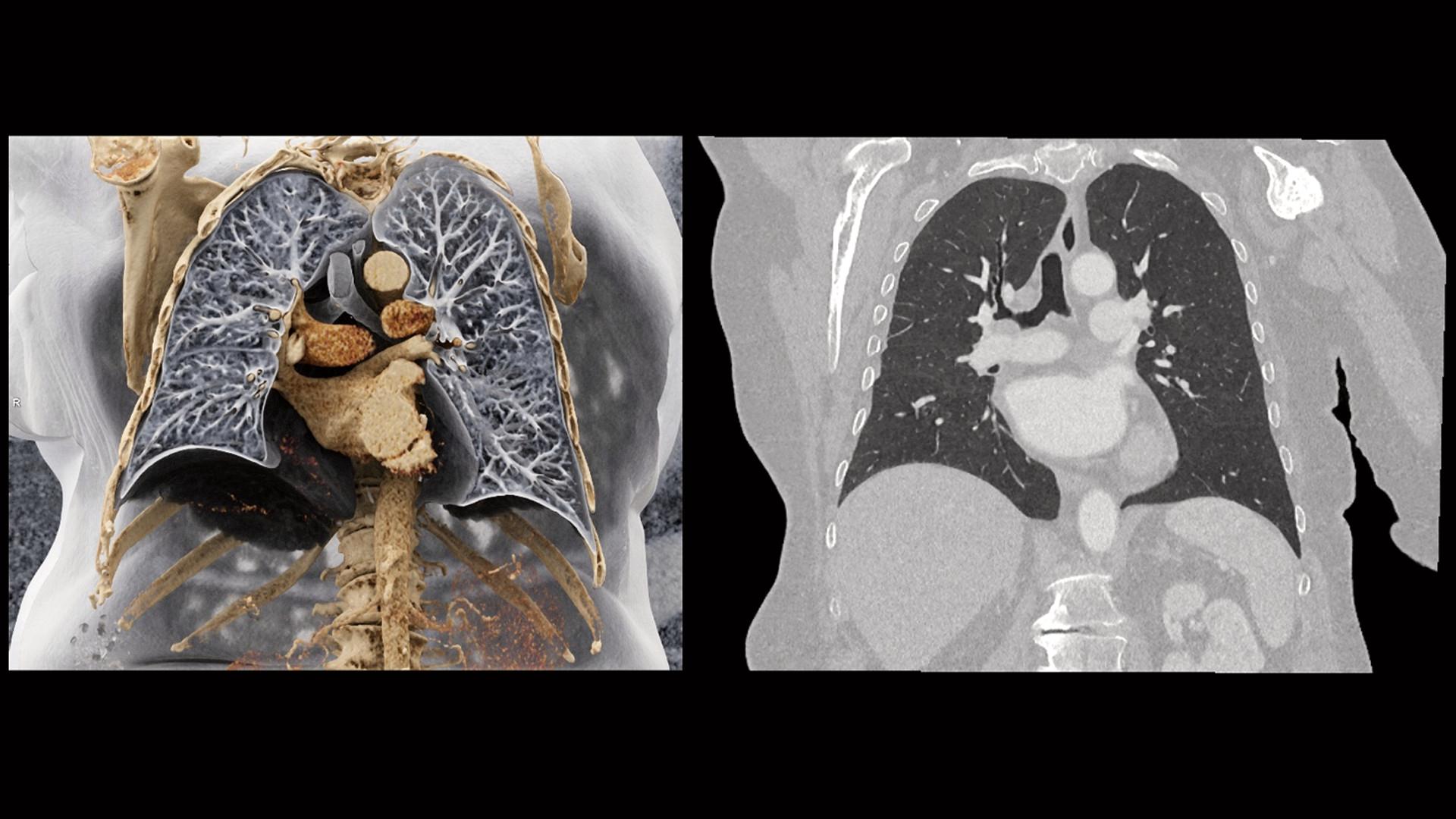 The Siemens Healthineers CT Imaging Chain - Siemens Healthineers