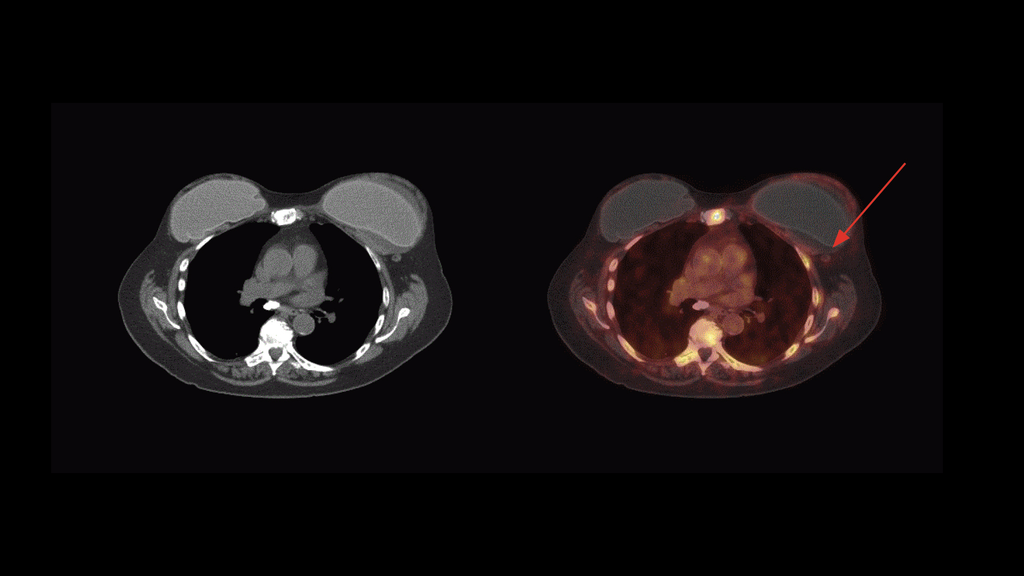 18F FES PET/CT imaging in recurrent metastatic invasive lobular breast ...