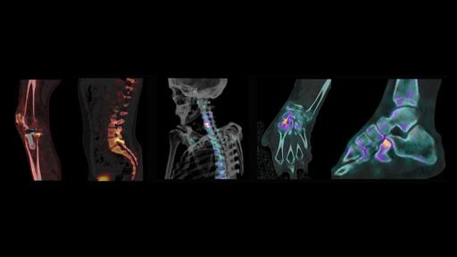 SPECT/CT In Orthopedics - Siemens Healthineers