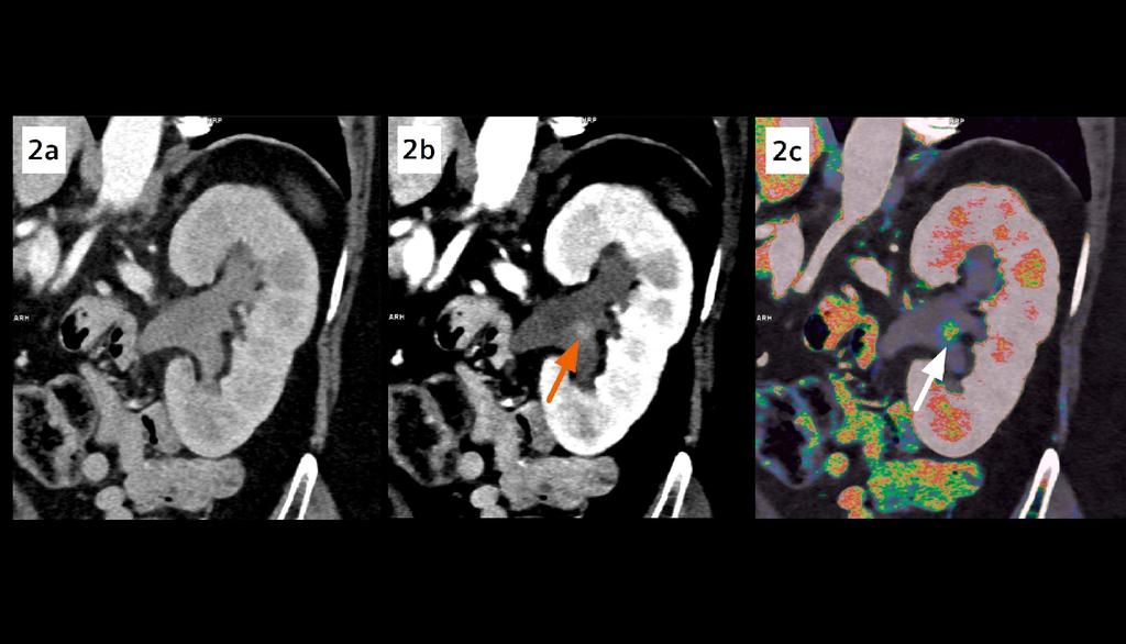 Severe ureteral obstruction secondary to an upper urinary tract ...