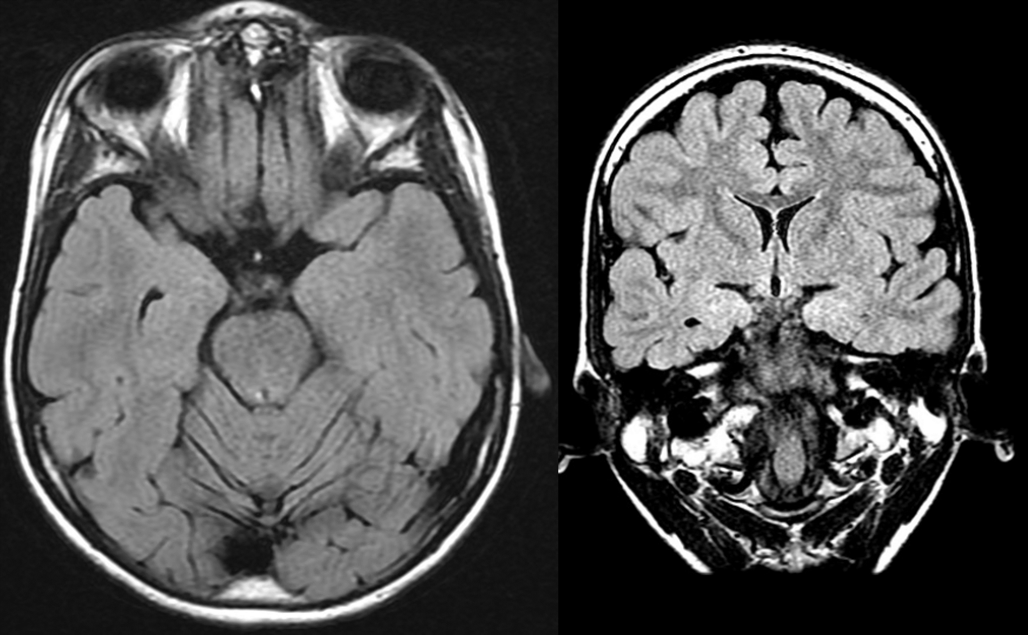 Decoding Brain Metabolism: Insights from 18F-FDG PET/CT Studies using ...