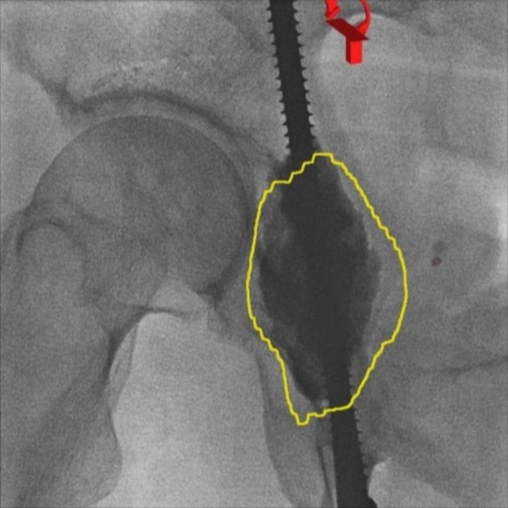 Interventional Oncology Procedures - Siemens Healthineers