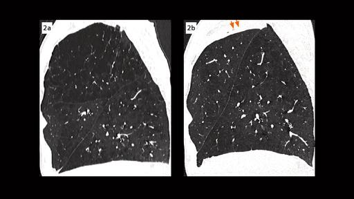 Severe emphysema treated with endobronchial valves - Siemens Healthineers