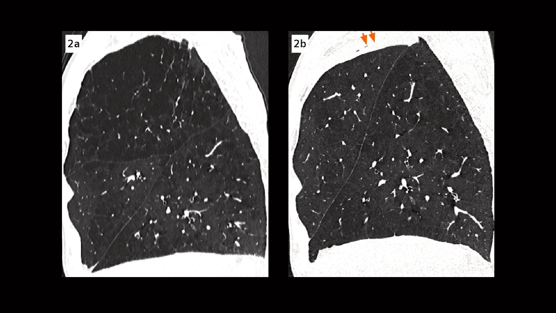 Severe emphysema treated with endobronchial valves