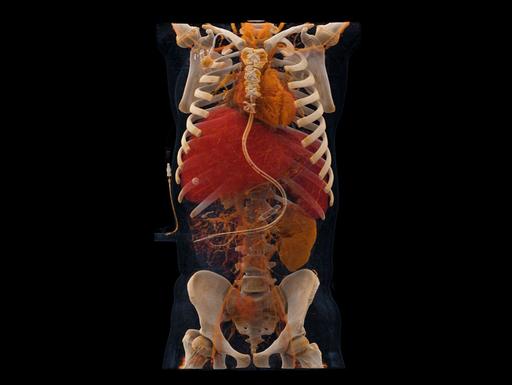Photon-counting CT by Siemens Healthineers: Quantum Technology ...